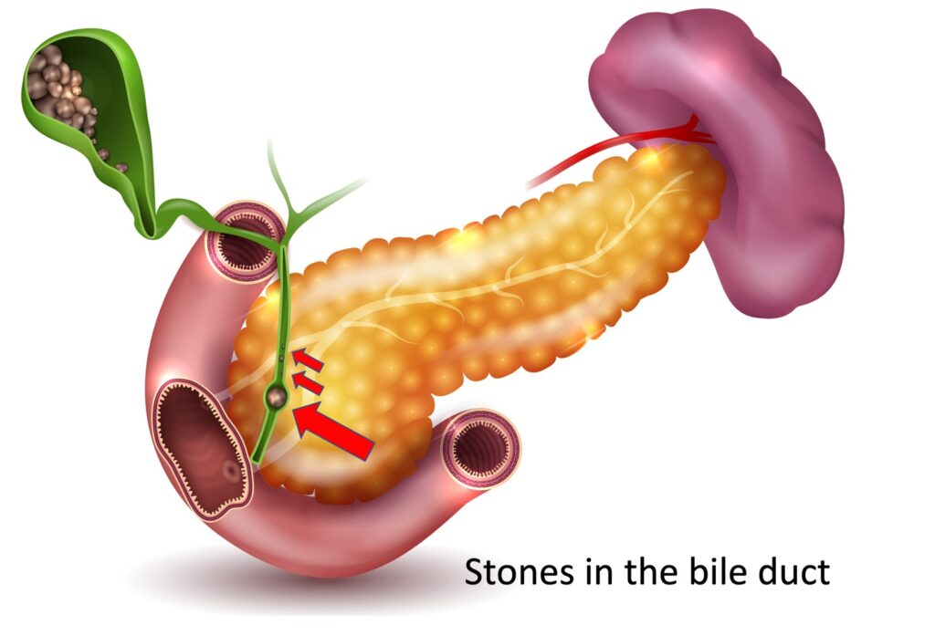 Bile Duct Surgery In Singapore | LS Lee Surgery Clinic
