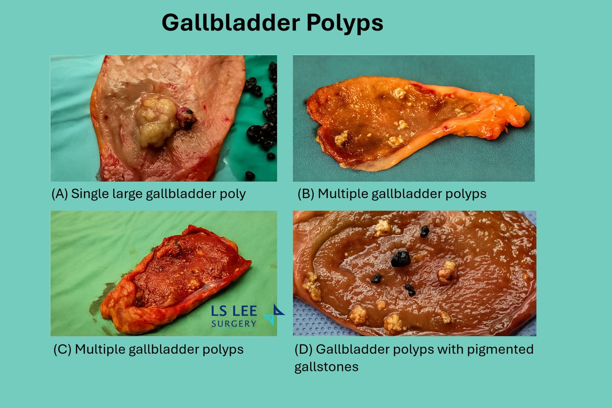 Gallbladder Polyps Singapore Causes Risks Treatment Options