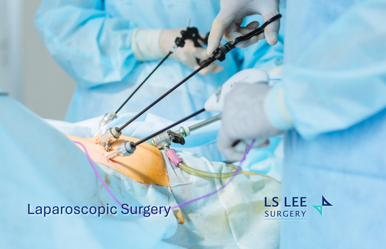 Laparoscopic Cholecystectomy Singapore | Keyhole Gallbladder Surgery