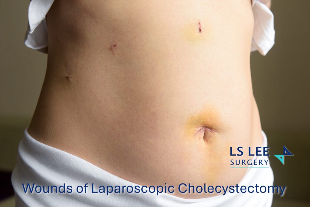 Laparoscopic Cholecystectomy Singapore Keyhole Gallbladder Surgery