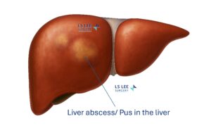Liver Abscess Treatment In Singapore | LS Lee Surgery Clinic