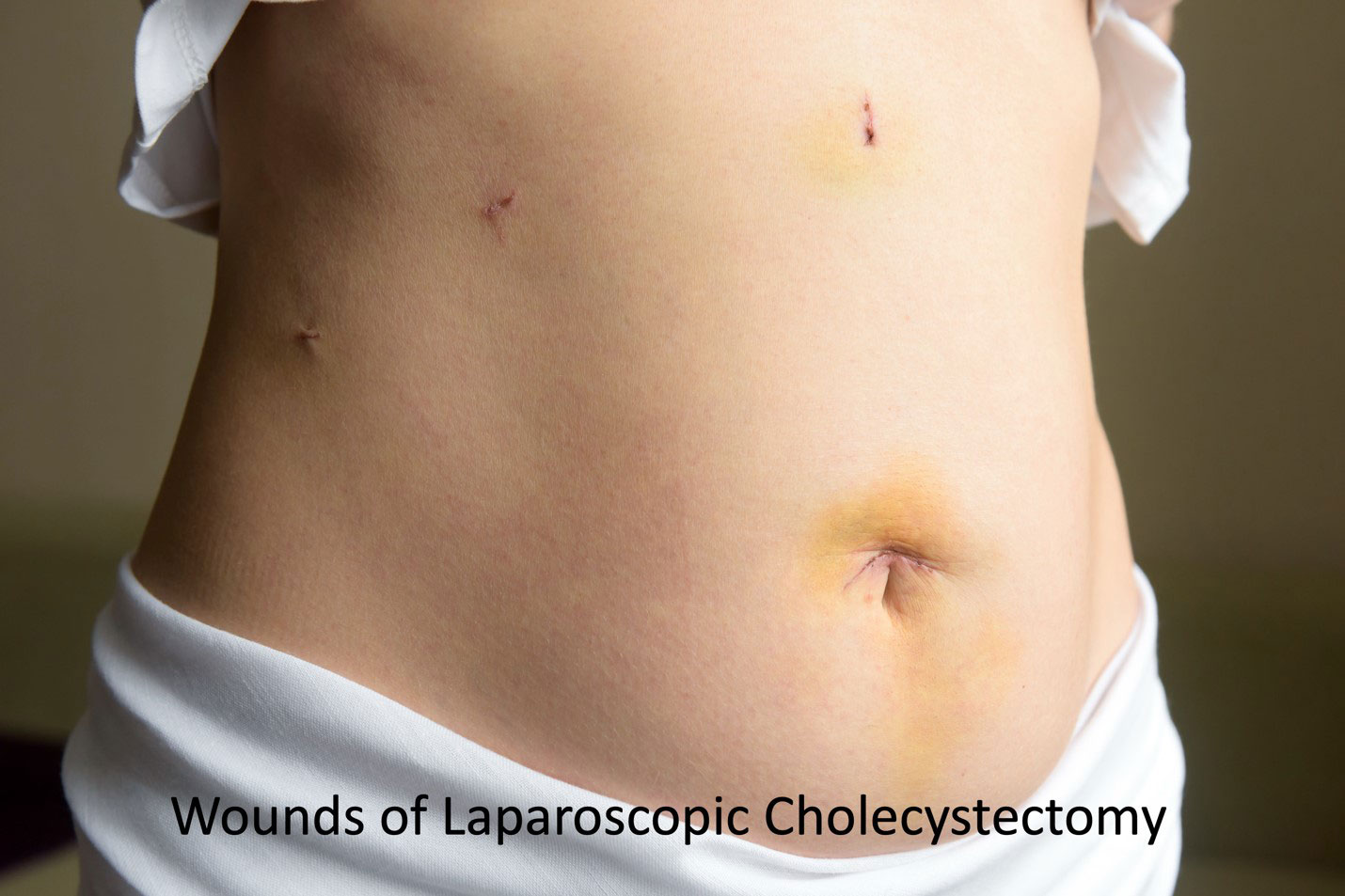 How Long Is Stomach Swollen After Laparoscopic Gallbladder Surgery