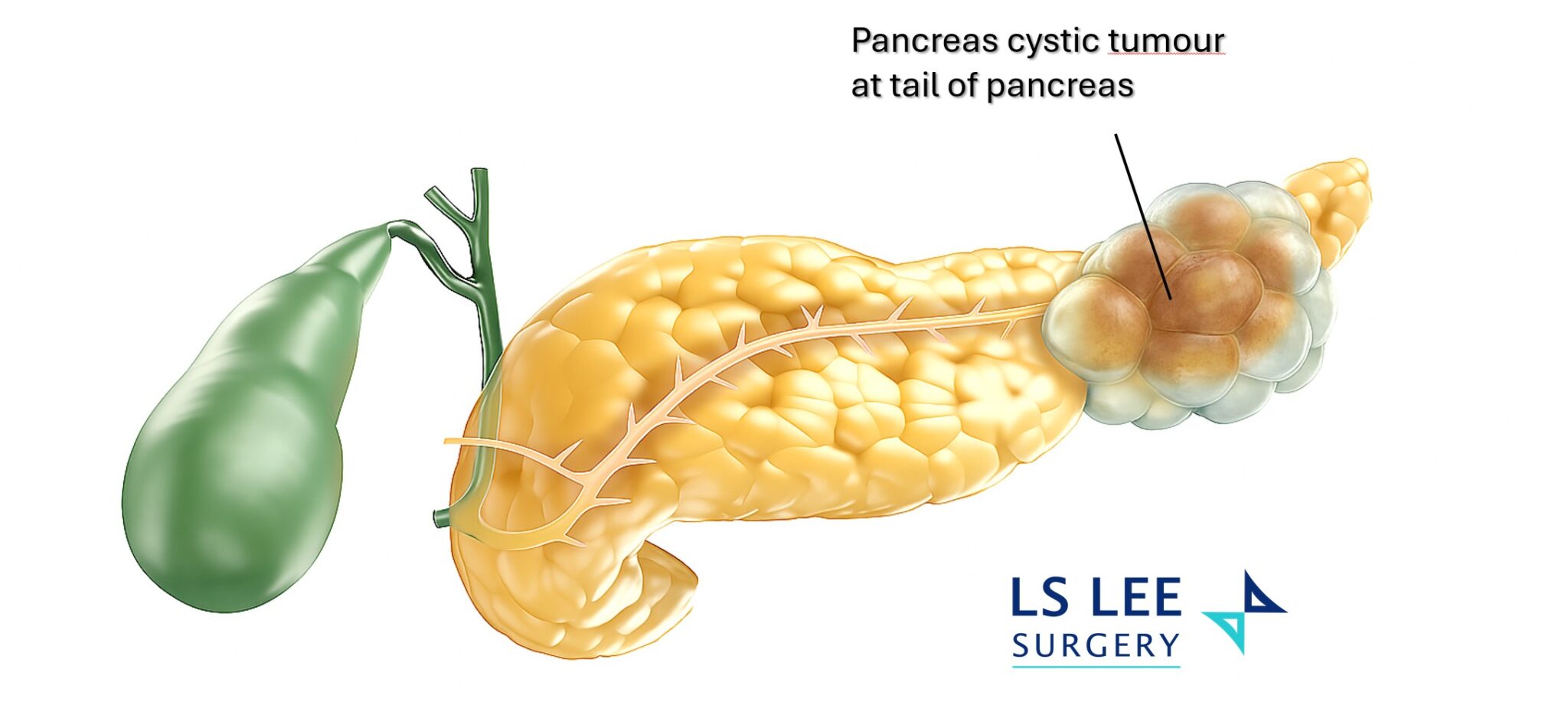 Pancreatic Cystic Neoplasms: Symptoms, Diagnosis & Treatment