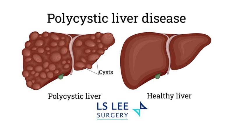 Can Liver Cysts Be Dangerous? - LS Lee Surgery