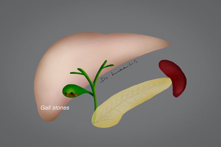 Gallstone Disease – LS Lee Surgery