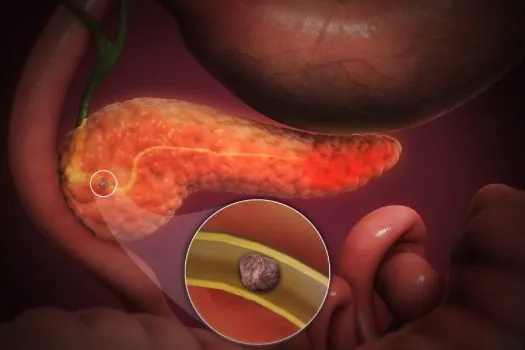 Acute Pancreatitis Treatment In Singapore | LS Lee Surgery Clinic
